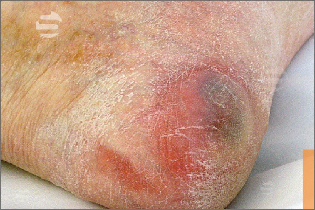 3 tips voor een betere hygiëne bij decubitus! - jacare